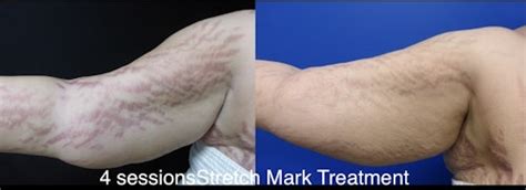 Stretch Mark Removal San Diego Laser Stretch Mark Removal