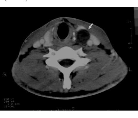 Figure 1 From Hydatid Cyst In Thyroid Gland A Case Report Semantic