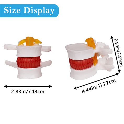 Human Anatomical Lumbar Disc Herniation Model Portable