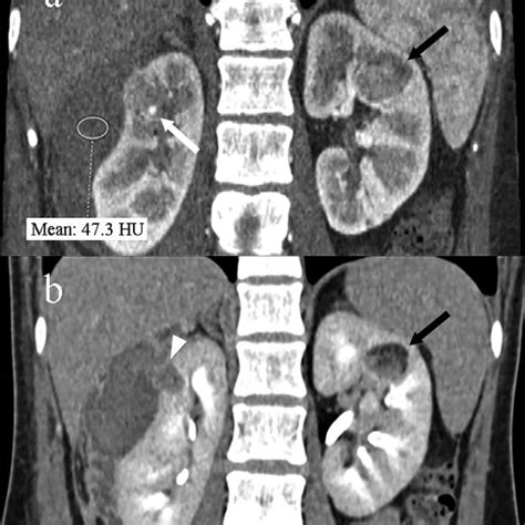 Pdf Use Of A Mixture Of Lipiodol And Cyanoacrylate In Percutaneous