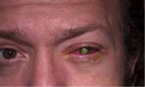 He Lost His Sight As A Result Of A Nightly Blunder We All Commit