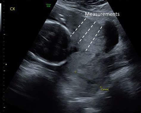 Measurement Technique Used For Placental Thickness Assessment With