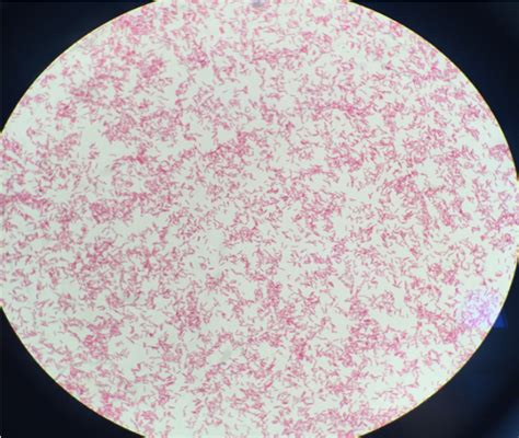 Fatal Legionella Pneumophila Serogroup 1 Pleural Empyema A Case Report