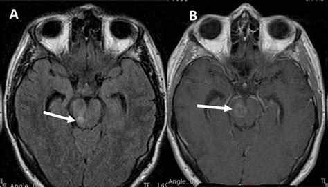 Midbrain Behçet Disease In A 32 Year Old Man Diagnosed By A Clinical