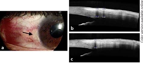 Figure 1 From Corneal And Conjunctival Calcification In A Dialysis Patient Reversed By