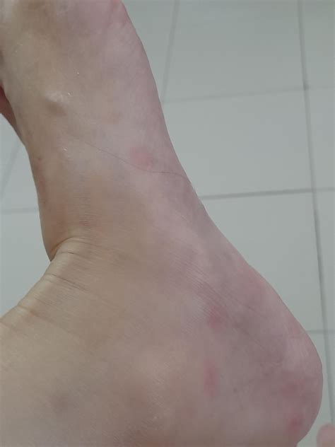 Fever Causing Hives Rurticaria