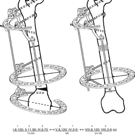 134 Epiphysiodesis Of The Proximal Tibia A Insertion Of The K Wire