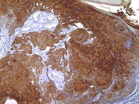 Pathology Outlines Inverted Follicular Keratosis