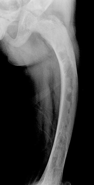 Fibrous Dysplasia Orthoinfo Aaos
