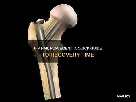 Hip Nail Placement A Quick Guide To Recovery Time Nailicy