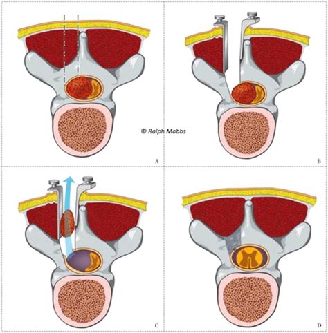 Unilateral Hemilaminectomy For Intradural Lesions Mobbs 2015