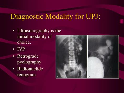Ppt Hydronephrosis Powerpoint Presentation Free Download Id318256