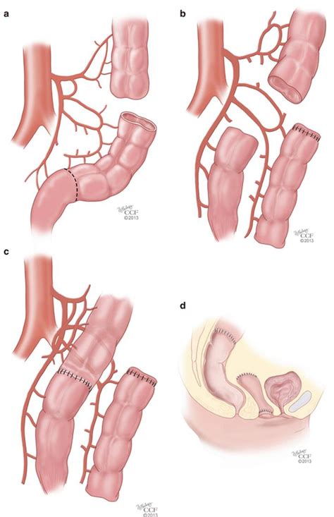 Construction Of The Neovagina Female Pelvic Surgery