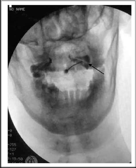 X Ray Image Open Mouth View Showing The Lateral Aaj Delineated By The