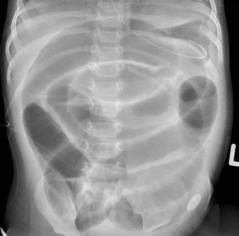 Pediatrics 91 Pediatric Abdomen And Retroperitoneum Case 912