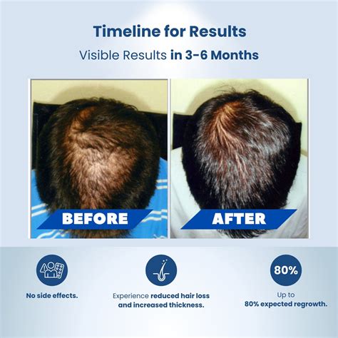 Hair Growth Kit Waidon