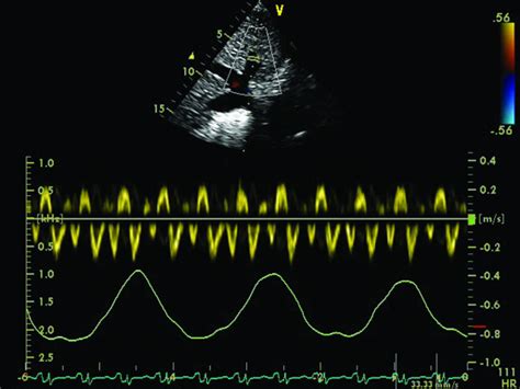 Constrictive Pericarditis Respiratory Variation Of Doppler Curve Of