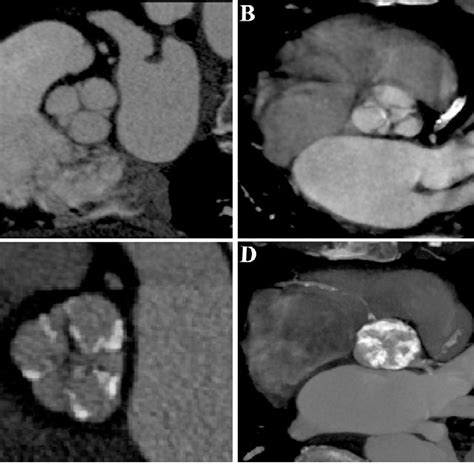 Aortic Cusp Calcification Grades In Mdct Double Oblique Transverse Mip