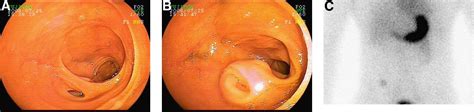 Meckels Diverticulum Diagnosed By Double Balloon Enteroscopy In An