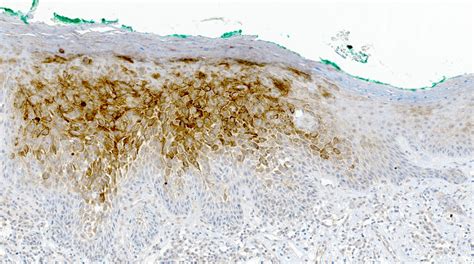 Pathology Outlines Hpv Independent Vin Vulva