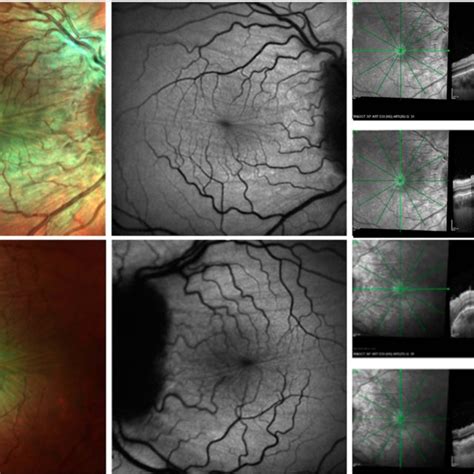 Pdf Recognition Diagnosis And Treatment Of Chorioretinal Folds