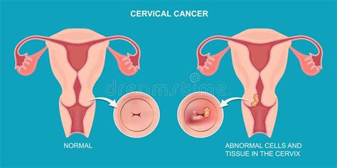 Cervical Cancer Is A Growth Of Cells That Starts In The Cervix Stock
