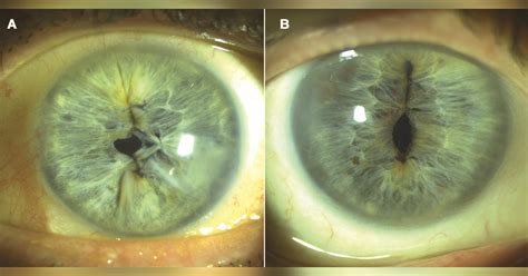 Short Learning Curve Results In Success With Pinhole Pupilloplasty
