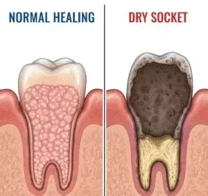 Pictures Of Granulation Tissue After Tooth Extraction Your Visual Guide To