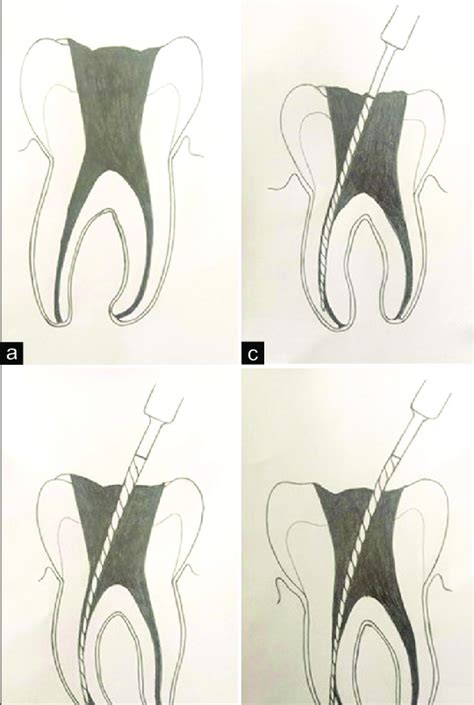 Schematic Representation Showing Normal Canal Morphology A Ledge Download Scientific Diagram