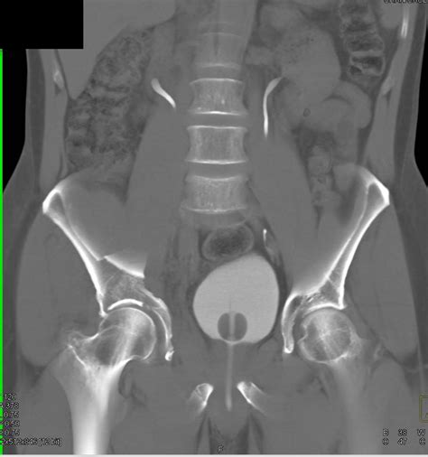 Pelvic And Acetabular Fractures With Normal Ct Cystogram
