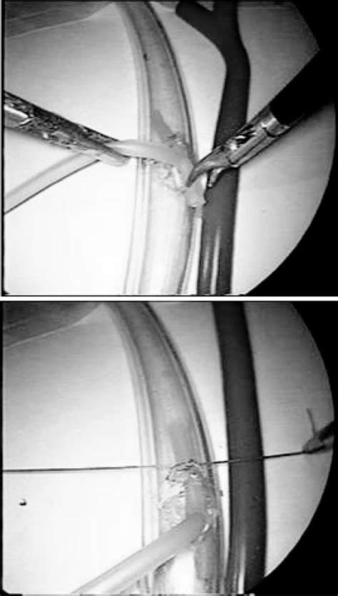 Laparoscopic Choledochotomy Model Download Scientific Diagram