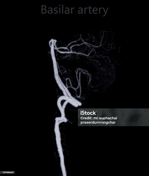 Ct Angiography Of The Brain Or Cta Brain Showing Basilar Artery Stock