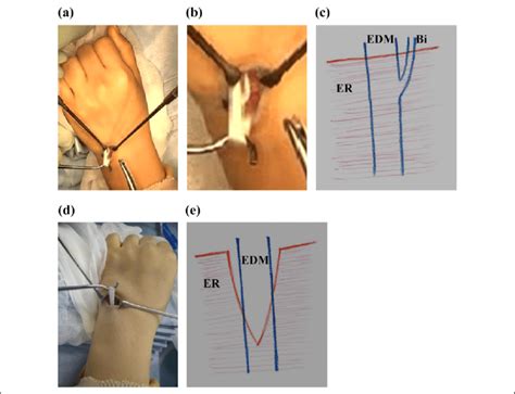 Intraoperative Photograph A The Edm Tendon Has Smaller Radial Slip