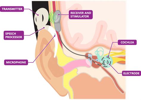 Cochlear Implant Surgery
