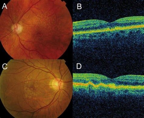 Zeiss Oct Roswell Eye Clinic