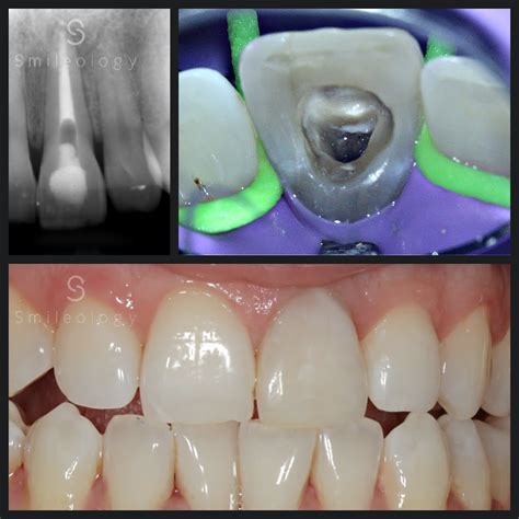 Root Canal Dentist Comprehensive Root Canal Treatment In Maidstone And Sevenoaks Kent