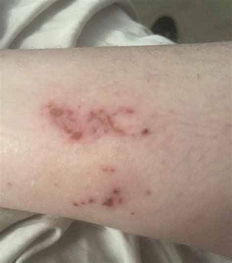 I 15f Have Been Getting Scabs That Show Up After A 2 5min Itching