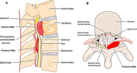 Spinal Epidural Abscess A Time Sensitive Diagnosis