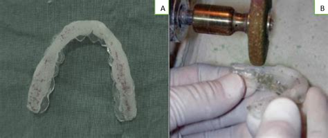 Occlusal Adjusted Of Flat Maxillary Occlusal Splint Aocclusal View Of