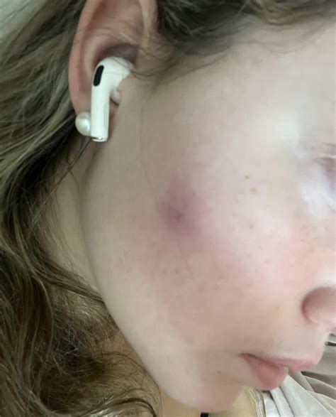 Is It Normal To Still Be Getting Pimples Here And There In The Later