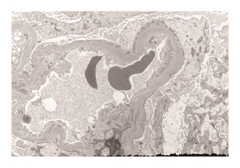 Electron Micrograph Of A Glomerular Capillary Shows Thickened Download Scientific Diagram