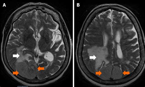 Atypical Presentation Of A Large Posterior Falx Meningioma Involving
