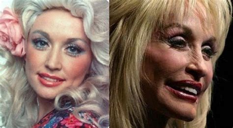 Dolly Parton Plastic Surgery Gone Wrong This Became The Talk Of The