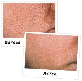 Medpeel Salicylic Acid 20 Essential Peel Kit Includes