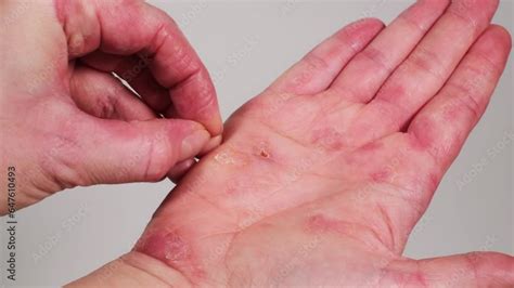 Woman Scratching Her Cracked Dry Skin Of Palm Red Stains On Female
