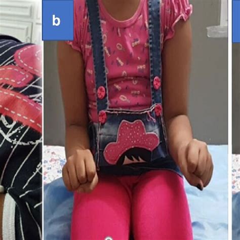 Diagrammatic Description Of Judet Classification Of Radial Neck