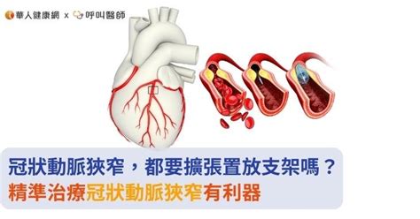 冠狀動脈狹窄，都要擴張置放支架嗎？精準治療冠狀動脈狹窄有利器 蕃新聞