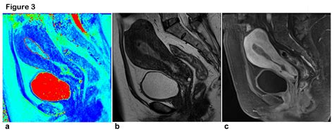 T2 Mapping Can Differentiate Endometrial Cancer From Benign Endometrial Lesions And Can