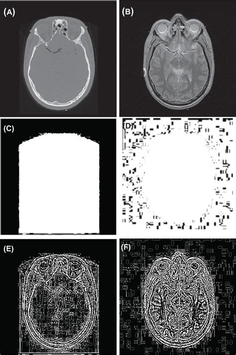 Image Fusion Based On Cross Bilateral And Rolling Guidance Filter Through Weight Normalization