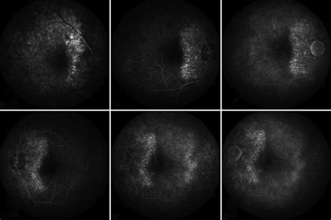Fundus Fluorescein Angiogram Of Both Eyes Early Phase A And D Mid Download Scientific